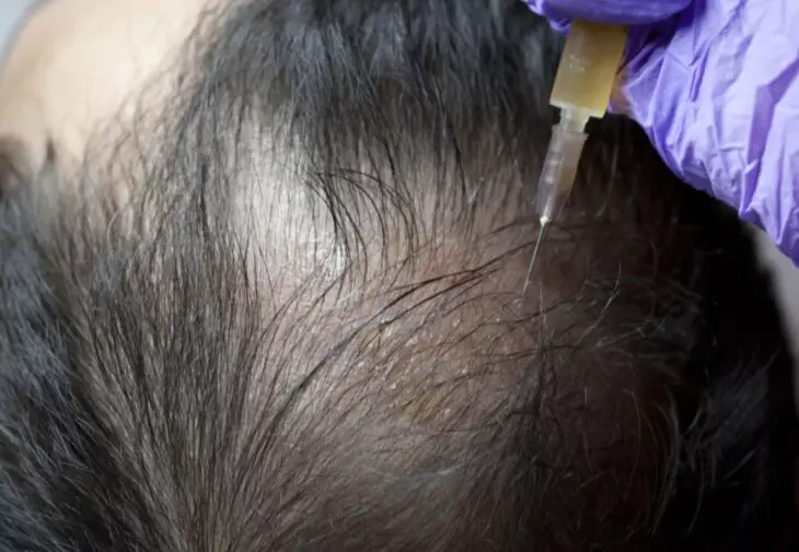 Los 8 mejores tratamientos anticaída del cabello para hombres en 2022 331_4