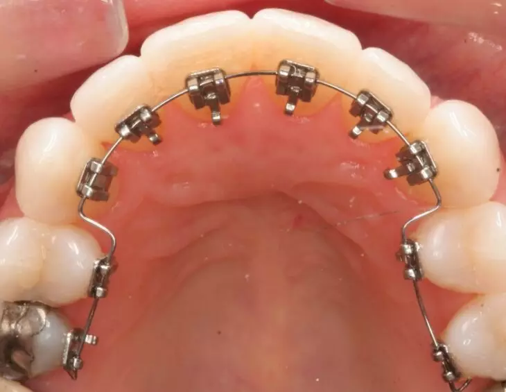 Chitsogozo Chanu Chotsimikizika cha Metal Braces 346_2