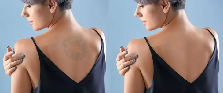 Avantages et inconvénients d'enlever les tatouages avec des lasers 35569_2