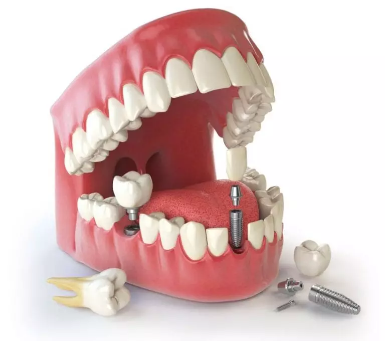 Мразя зъбните протези? Зъбните импланти може да са отговорът 3696_2