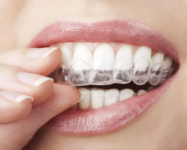 Populiariausi ortodontiniai gydymo būdai įžymybėms 38004_1