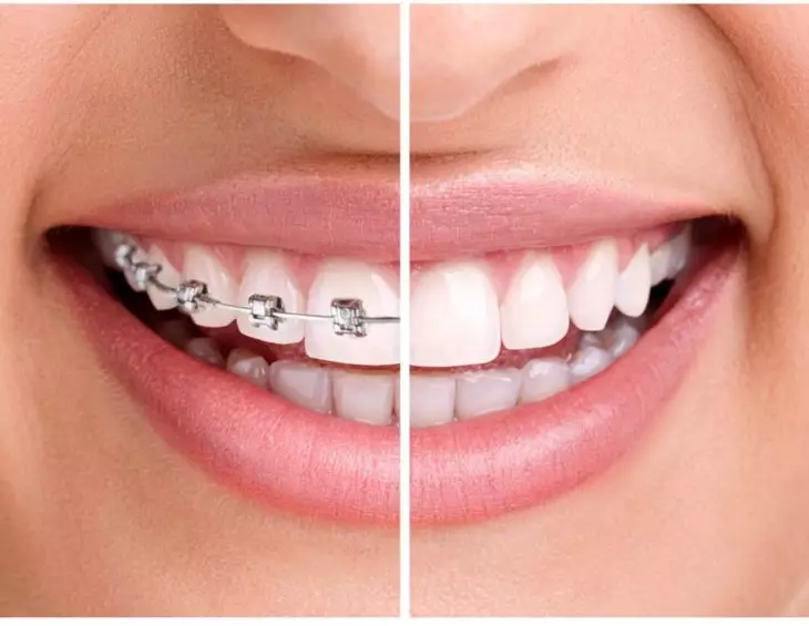 Populiariausi ortodontiniai gydymo būdai įžymybėms 38004_2