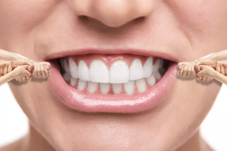 Najobľúbenejšie ortodontické ošetrenia celebrít 38004_4