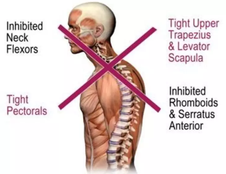 Qu'est-ce que la loi de Wolff et comment est-elle liée à la posture et à la santé musculo-squelettique 40216_5