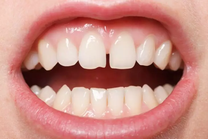 12 Inonyanya Kuzivikanwa Dental Procedures 40480_2