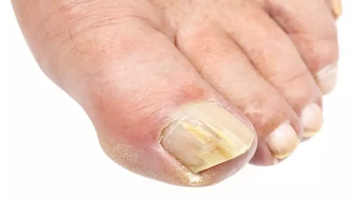 Mokhoa oa ho phekola Nail Fungus 4066_2