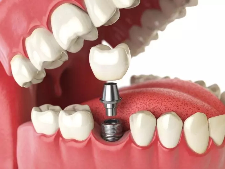 3 das Últimas Tecnoloxías en Odontoloxía Estética 4095_6