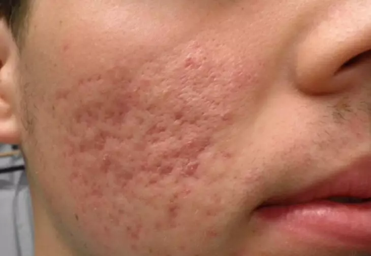 Di adeus ás cicatrices do acne: 6 tratamentos eficaces 4659_1