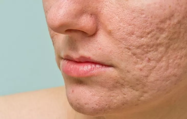 Dites adieu aux cicatrices d'acné : 6 traitements efficaces 4659_2