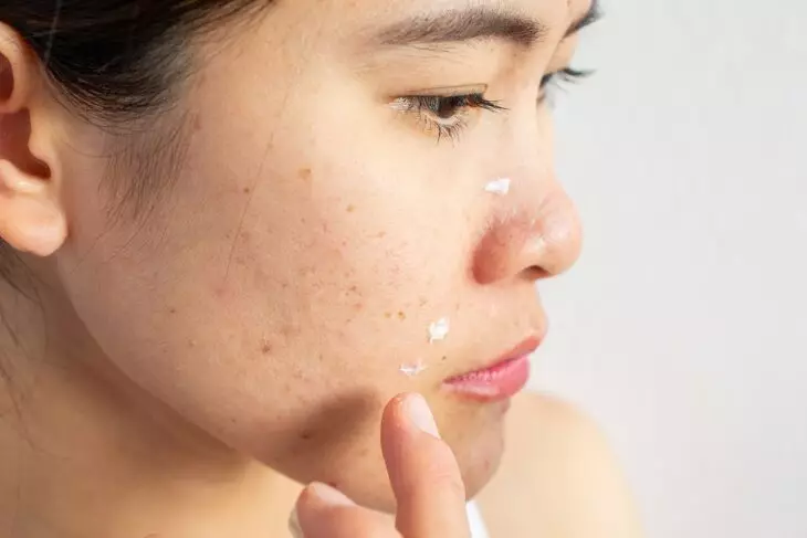 Digues adéu a les cicatrius de l'acne: 6 tractaments efectius 4659_4