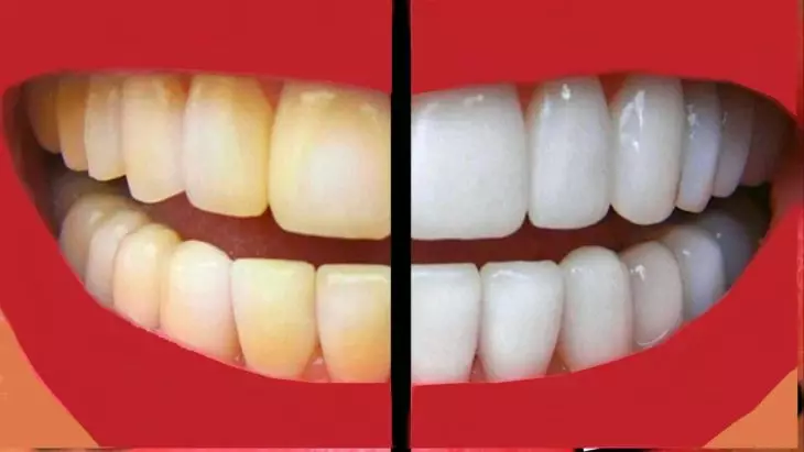 Ատամների սպիտակեցման 5 մեթոդ, որոնք դուք պետք է իմանաք 4701_2