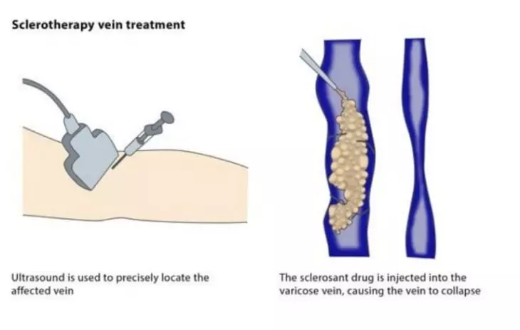 Inodzidzisa Inotungamira kune Varicose Veins Kurapa Sarudzo 47537_1