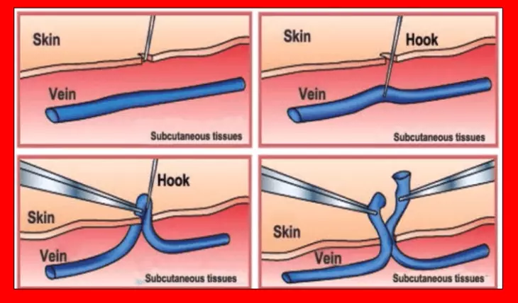 Hướng dẫn thông tin về các lựa chọn điều trị giãn tĩnh mạch 47537_2