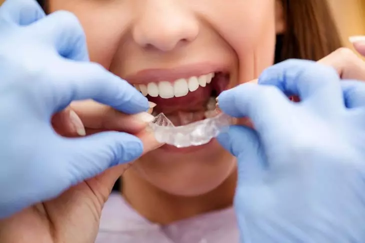 Orthodontics - ihe nkwado: I kwesịrị iyiri ha? 4782_2