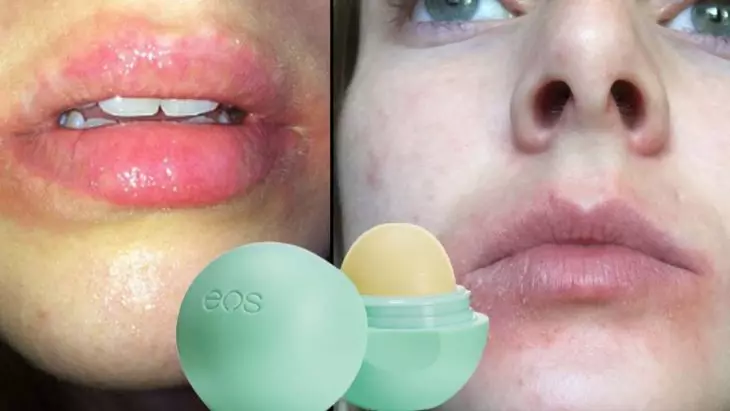 人们起诉润唇膏品牌 EOS 涉嫌引起皮疹和水泡 50157_2