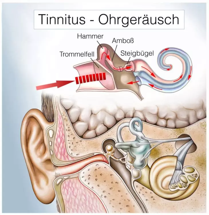 مون کي Tinnitus آهي 54614_2