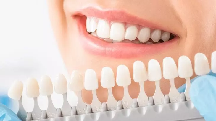 Mest populære kosmetiske tannbehandlinger 55201_1