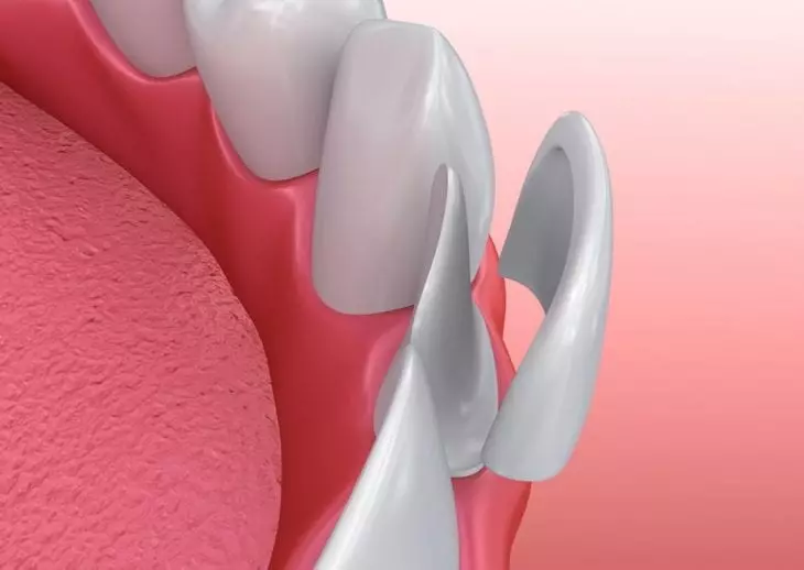 सबसे लोकप्रिय कॉस्मेटिक दंत चिकित्सा उपचार 55201_2