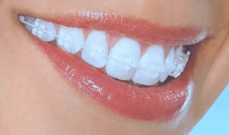 Ең танымал косметикалық стоматология процедуралары 55201_3