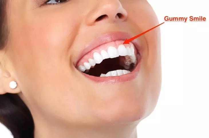 सबसे लोकप्रिय कॉस्मेटिक दंत चिकित्सा उपचार 55201_4
