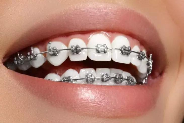 सर्वात सामान्य दंत प्रक्रिया 6599_1