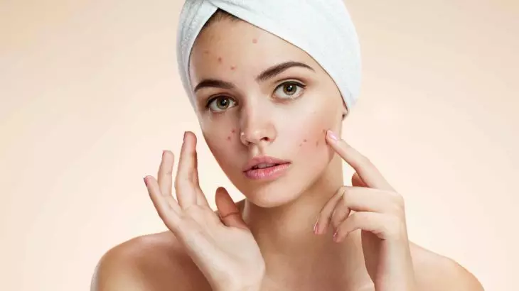 Sbarazzati dell'acne con questi metodi naturali 6953_1