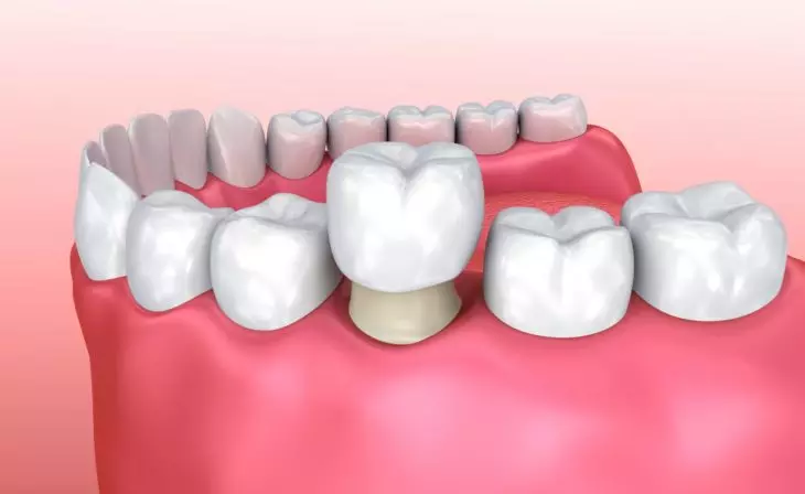 Čo robiť v prípade zlomených zubov? 7134_3