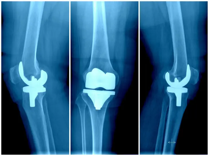 Com ha millorat la microcirurgia mitjançant la tecnologia 8336_3